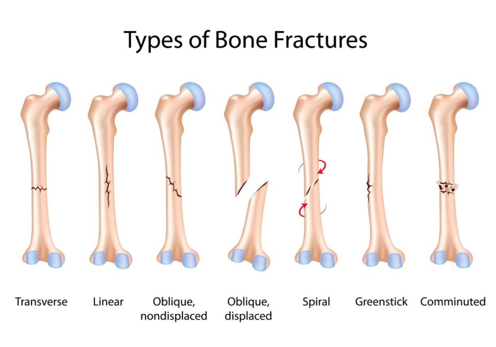 Bone Fractures: Types, Treatment, and Healing Tips