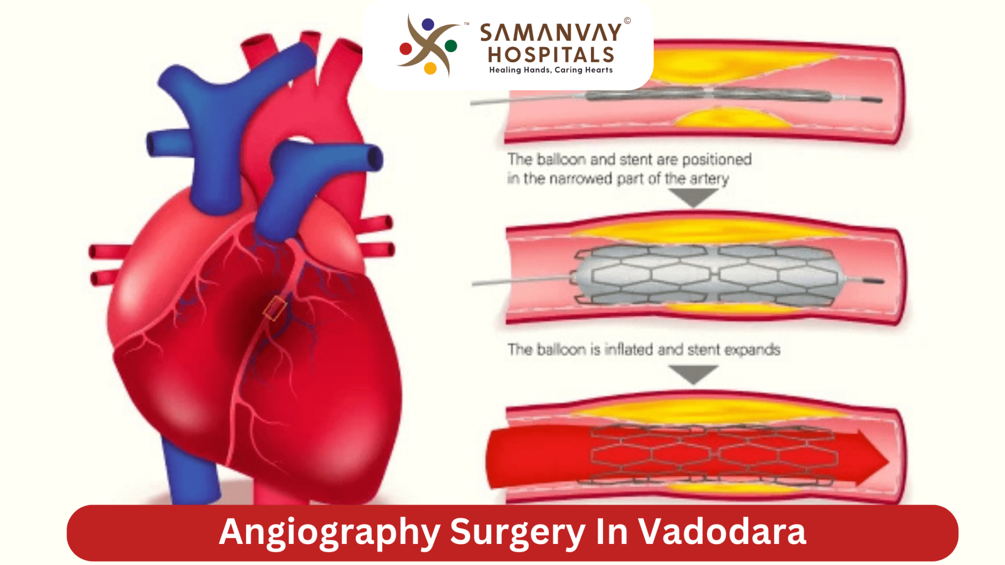 Angiography Surgery in Vadodara | Samanvay Hospital