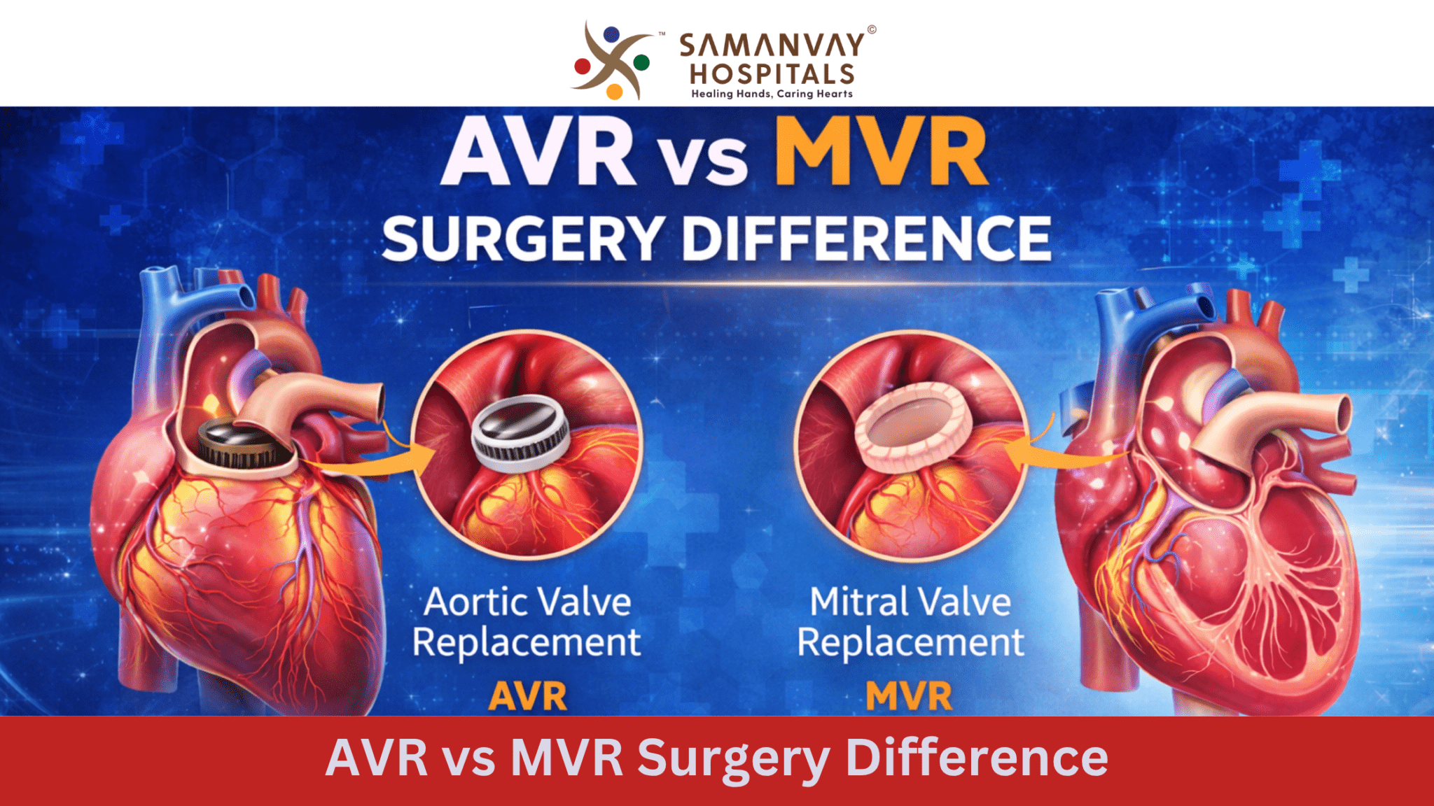 AVR vs MVR Surgery Difference | Samanvay Hospital